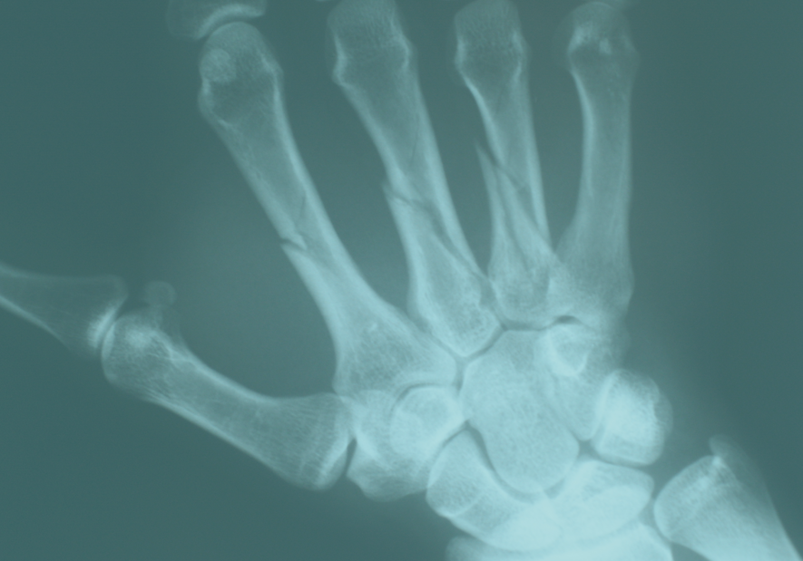 Therapie von Metakarpalfrakturen mit Intrinsic-Plus-Stellung
